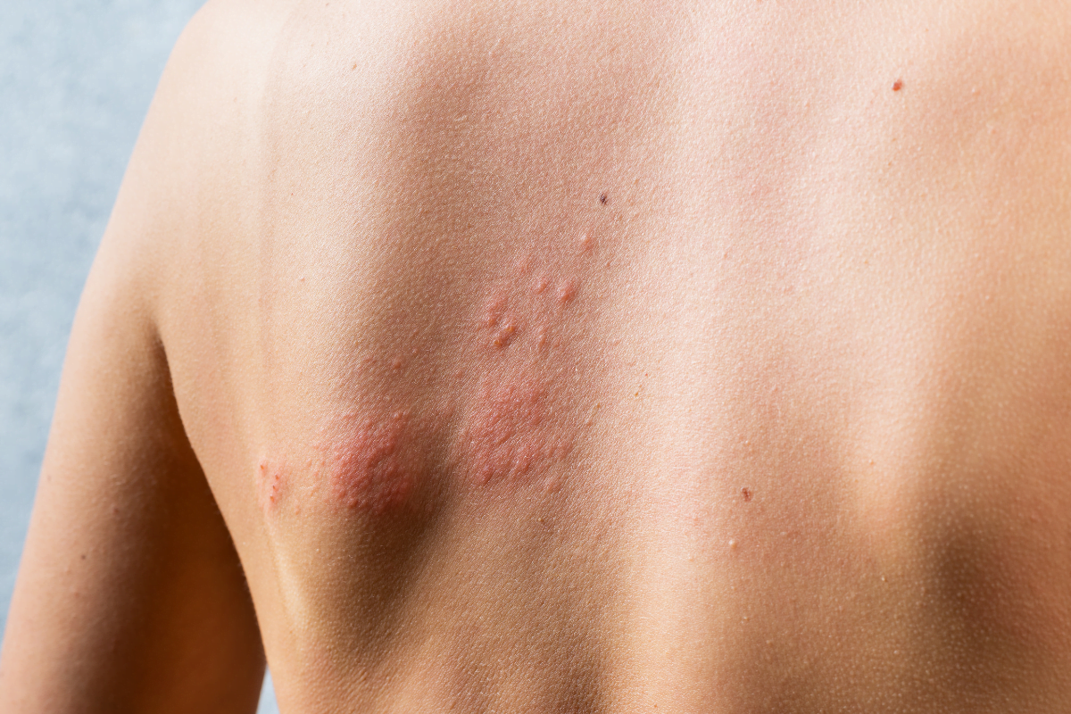 Treatment and Management Strategies for Porphyria Cutanea Tarda Read ...